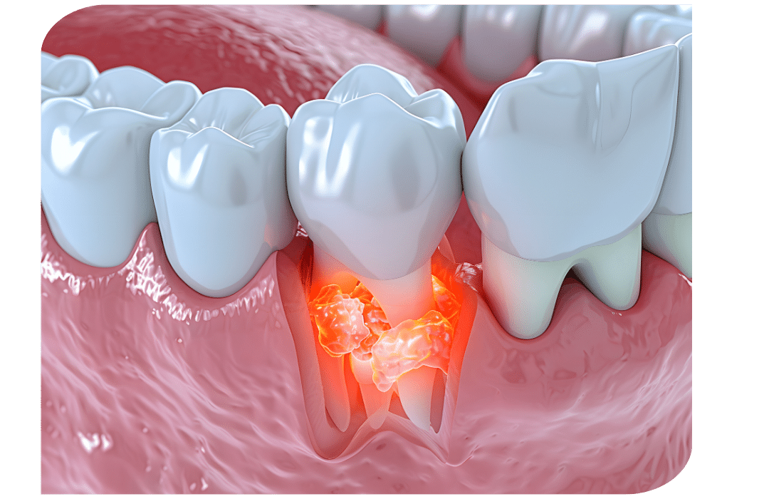 Gum Disease Treatment in West End Brisbane | West End Dental